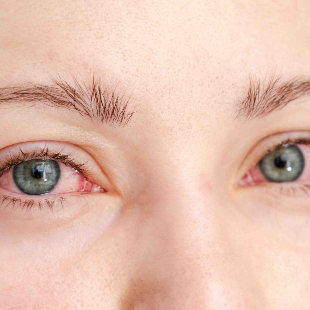 Kenali Penyebab dan Cara Efektif Mengatasi Mata Merah - EMC Healthcare ...