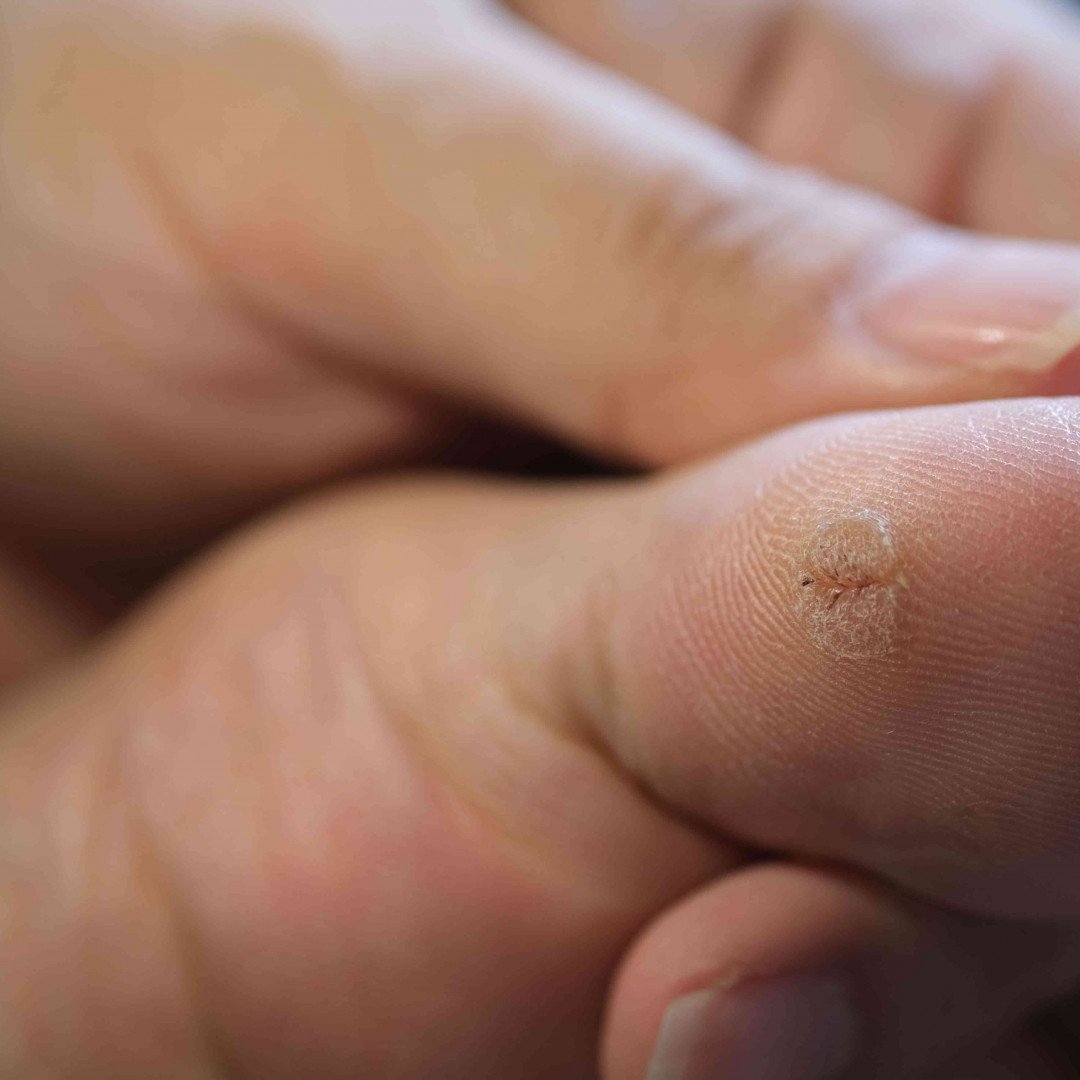 Penyebab dan Cara Mengatasi Mata Ikan dengan Tepat - EMC Healthcare - SAME