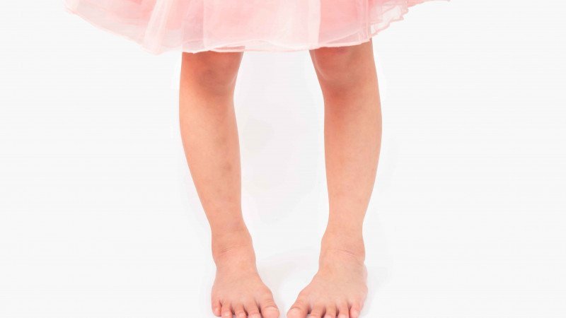 Lower Leg Deformities: X and O Legs, When Should You See a Doctor ...