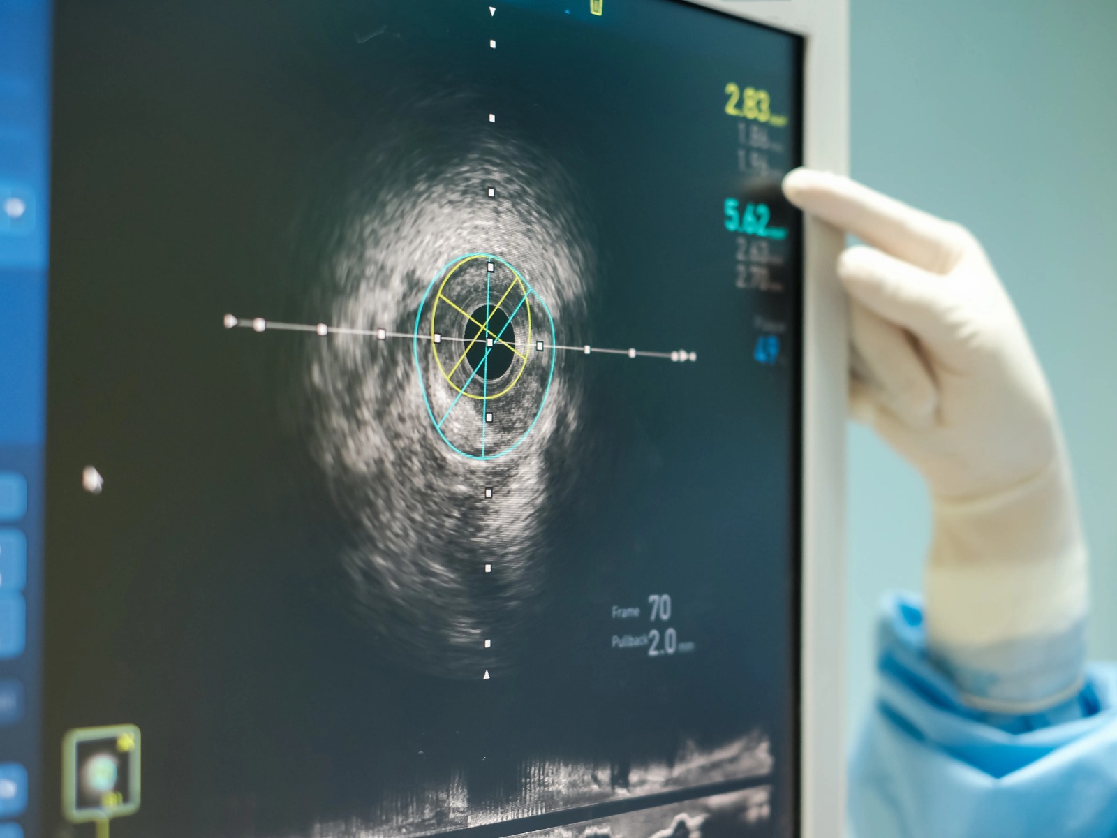 IntraVascular Ultrasound (IVUS) untuk Pembuluh Darah Jantung Koroner ...